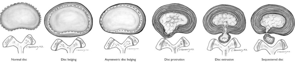 Disc Bulge - Star Physio. Expert Physiotherapy and Podiatry Care.