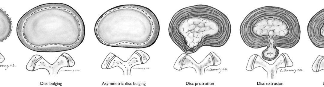 Disc Bulge Pictures - Star Physio. Expert Physiotherapy Care.